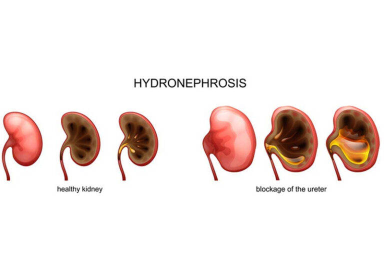 Hydronephrosis - UCI Pediatric Urology