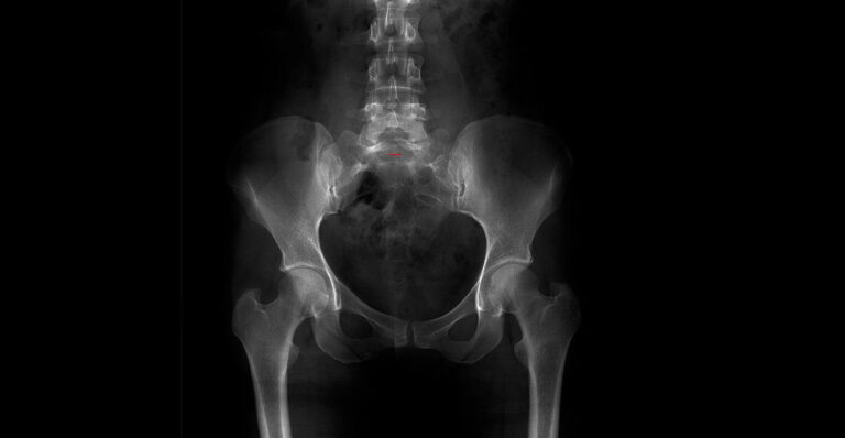 Cloacal Exstrophy - UCI Pediatric Urology