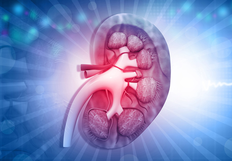 Ureterovesical Junction Obstruction - UCI Pediatric Urology