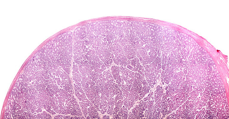 Undescended Testicle - UCI Pediatric Urology